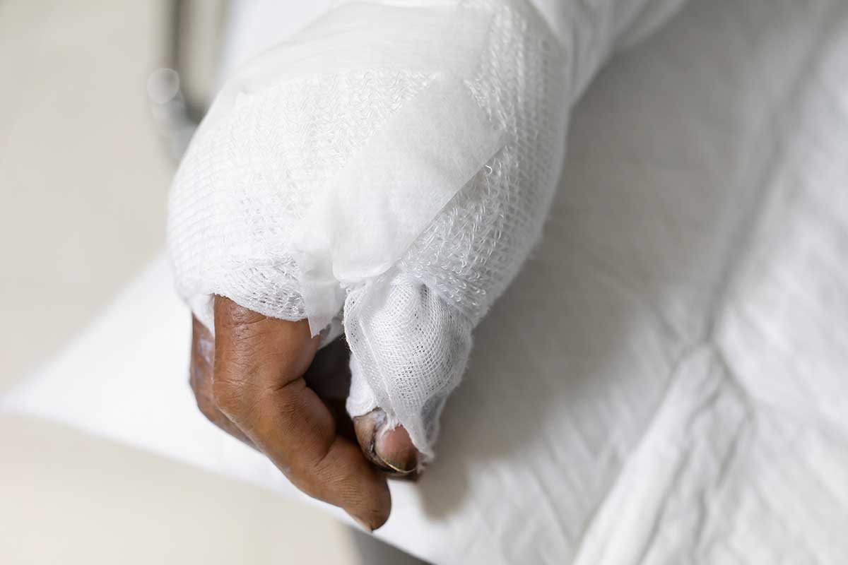 Burn Injuries: Understanding Liability & Compensation - Settlement Ally